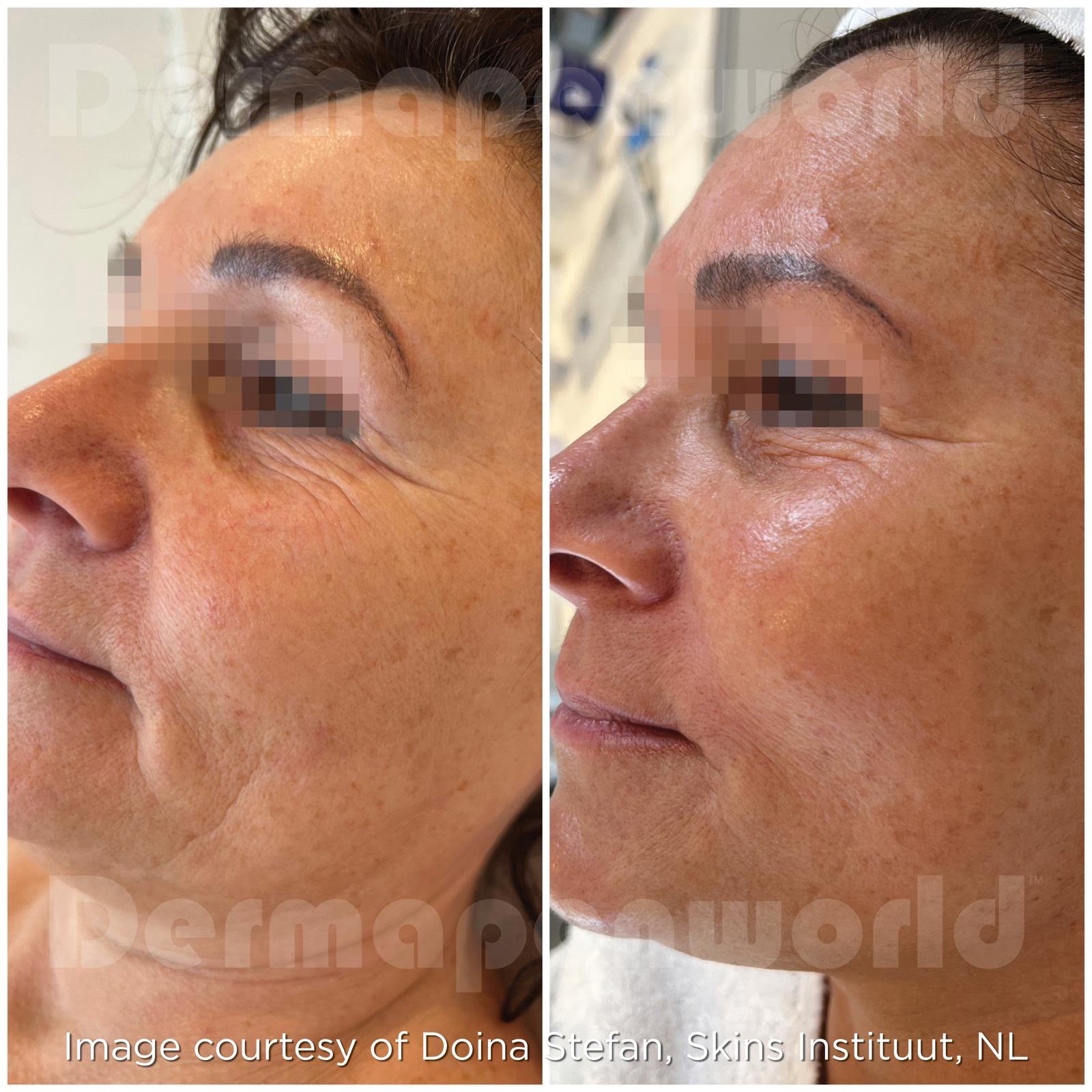 Dermapen 4 & Exosomes - Discover Skin Treatment Birmingham