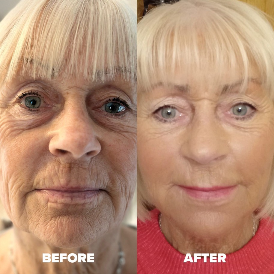 aesPLLA - Collagen Stimulator - Restore Volume Loss